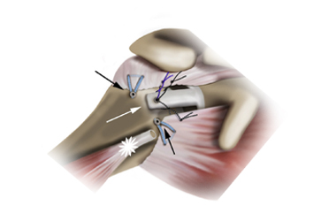 Pune Shoulder Course 2023 | Pune